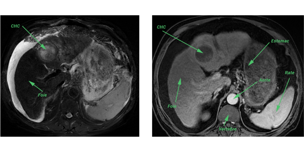Cancer du foie (CHC) - AFEF