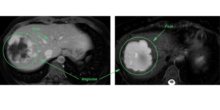 Tumeurs hépatiques bénignes - AFEF