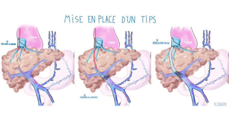 TIPS : TRANSJUGULAR INTRAHEPATIC PORTO-SYSTEMIC SHUNT - AFEF
