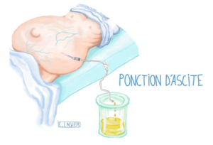 Hypertension portale – AFEF